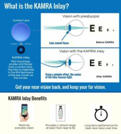 Correcting Presbyopia with the KAMRA Inlay Implant | IQ Laser Vision ...