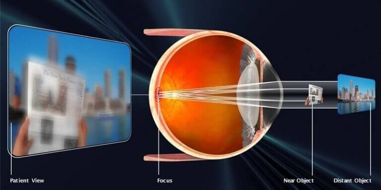 Vision Problems Los Angeles | Cataracts San Francisco | IQ