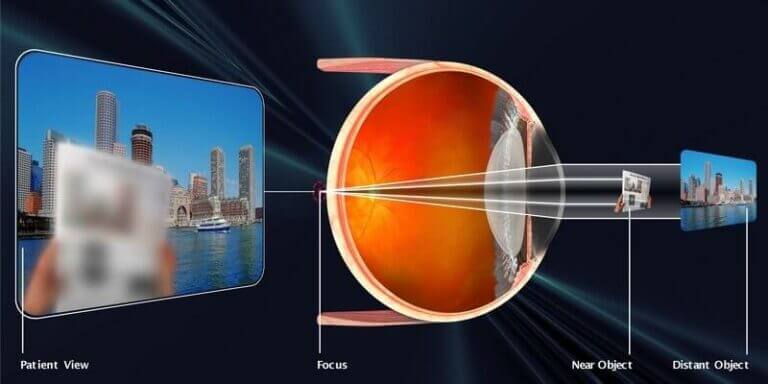 Vision Problems Los Angeles | Cataracts San Francisco | IQ