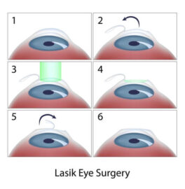 LASIK Flap: Everything You Need To Know | IQ Laser Vision: LASIK ...